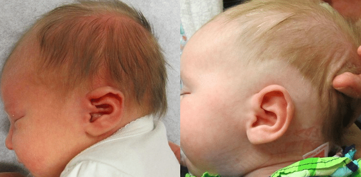 Is EarWell™ Safe for My Baby? | Wilson Plastic Surgery