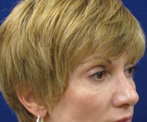 Case #3690 - Wilson Plastic Surgery