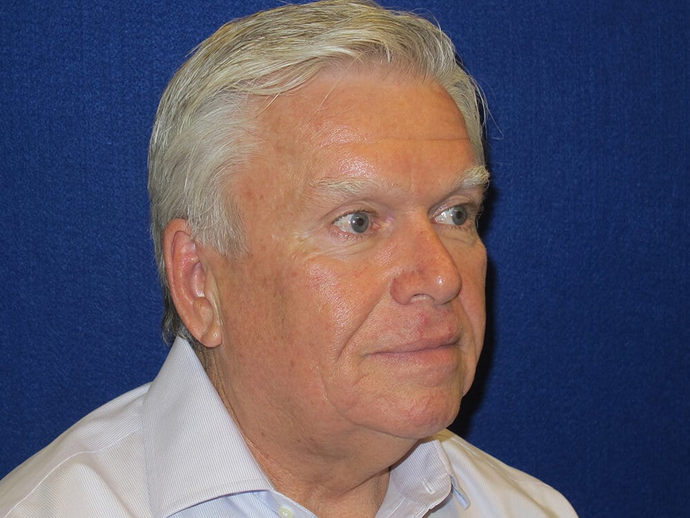 Case #3325 - Wilson Plastic Surgery