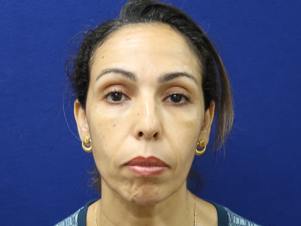 Case #6912 - Wilson Plastic Surgery