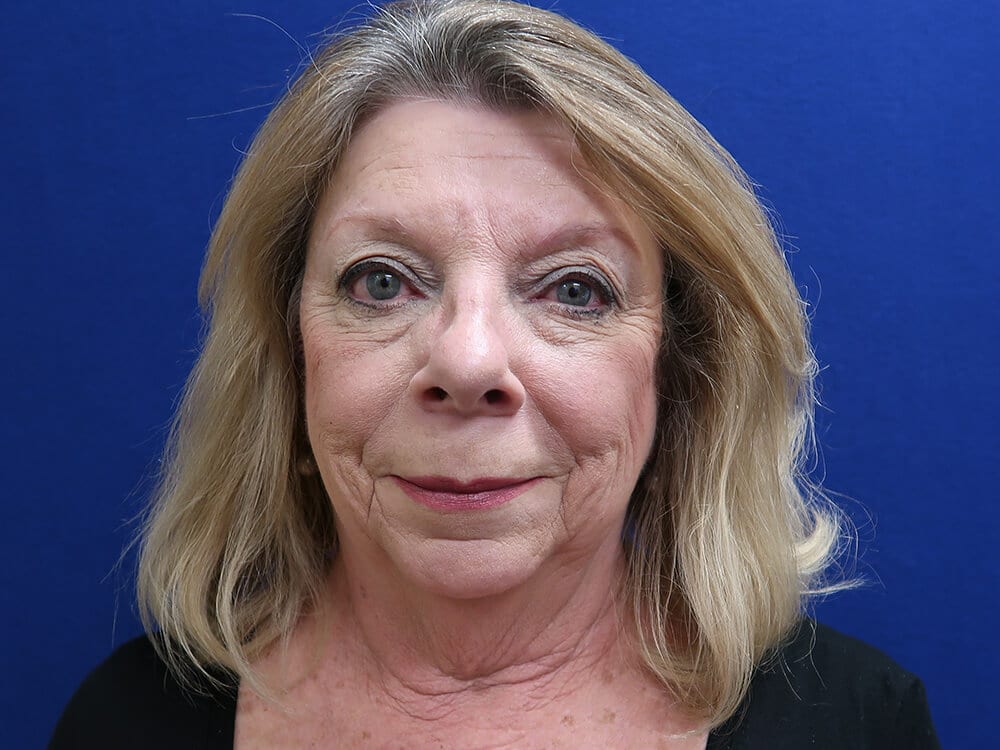 Case #4847 - Wilson Plastic Surgery