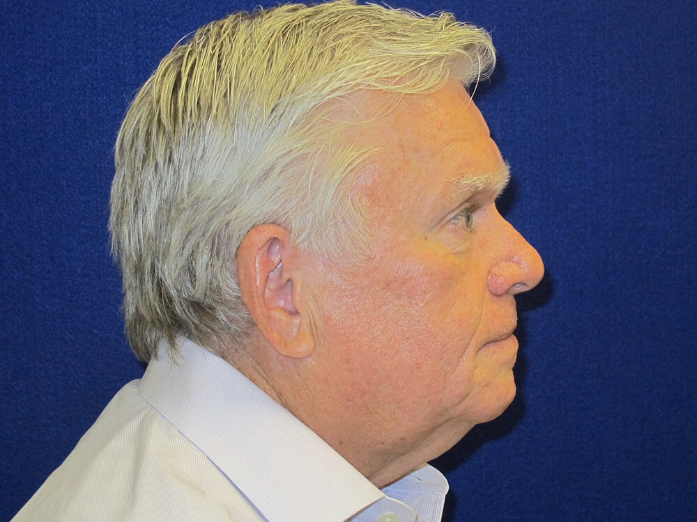 Case #3325 - Wilson Plastic Surgery