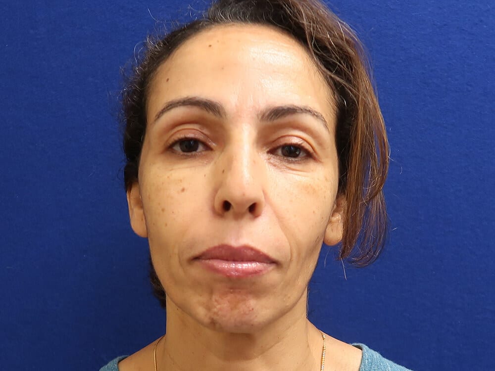 Case #6912 - Wilson Plastic Surgery