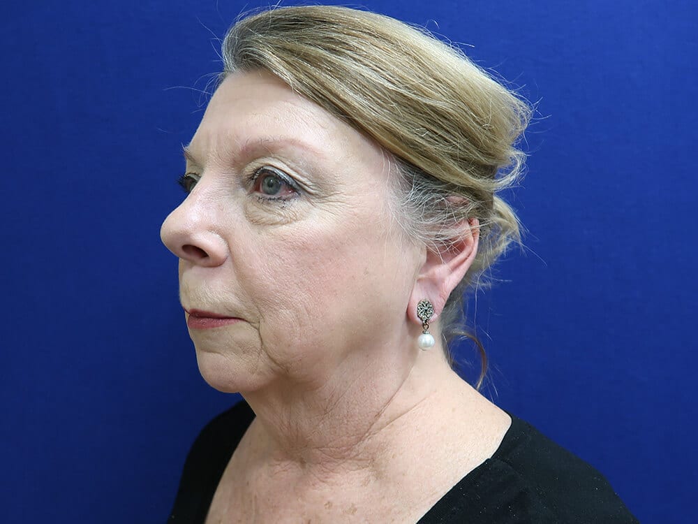 Case #4847 - Wilson Plastic Surgery