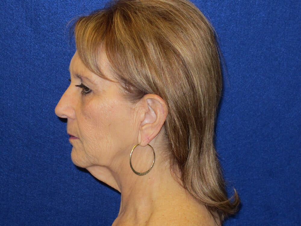 Case #2576 - Wilson Plastic Surgery