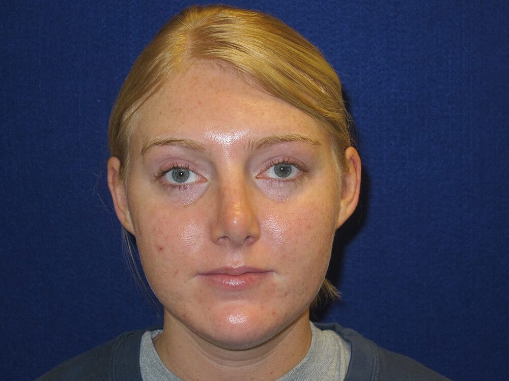 Rhinoplasty Archives - Wilson Plastic Surgery