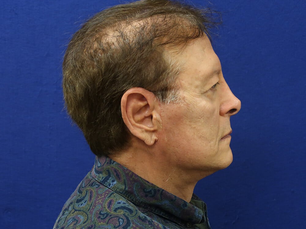 Case #1963 - Wilson Plastic Surgery