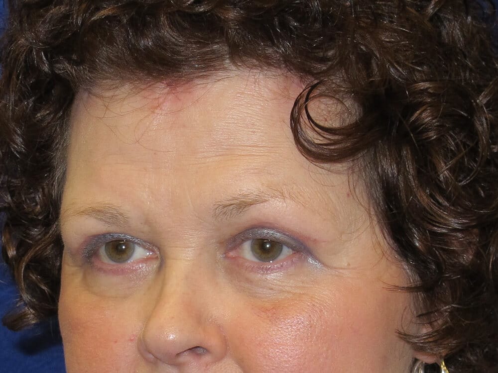 Case #5758 - Wilson Plastic Surgery