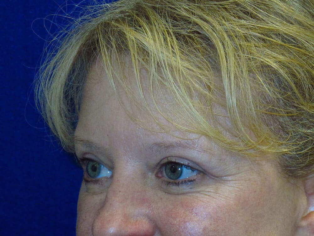 Case #2641 - Wilson Plastic Surgery