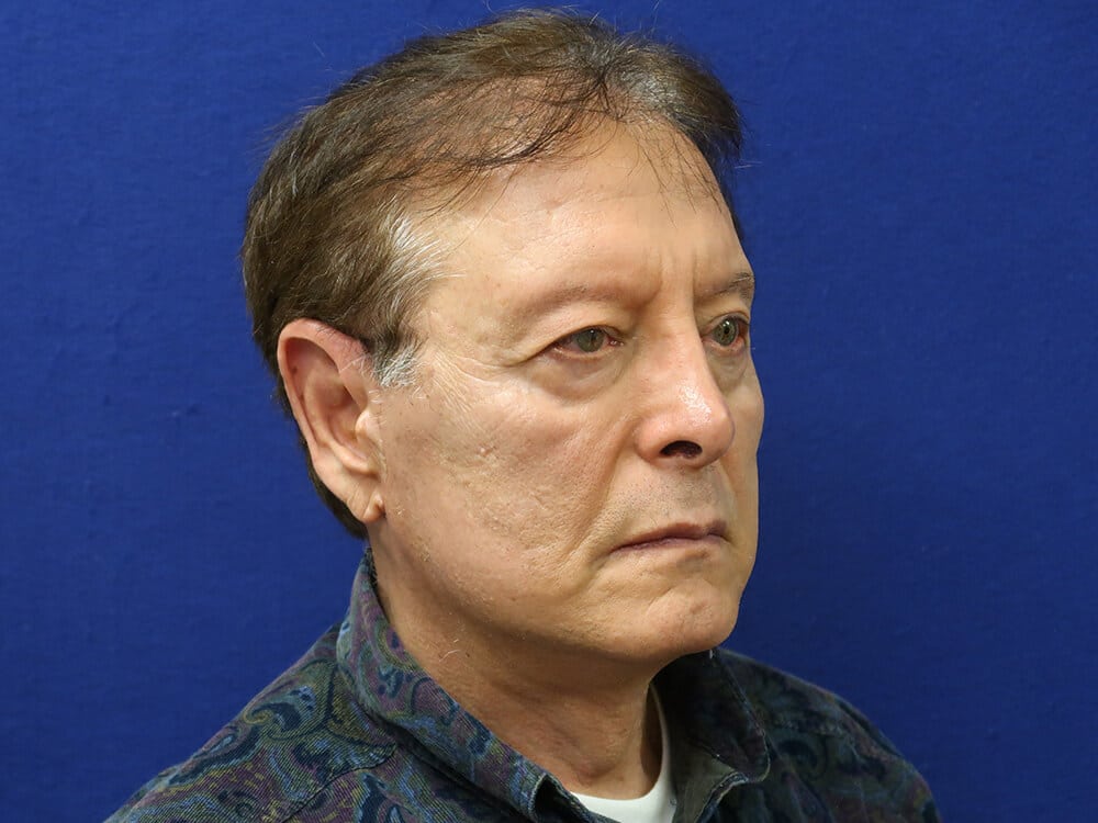 Case #1963 - Wilson Plastic Surgery