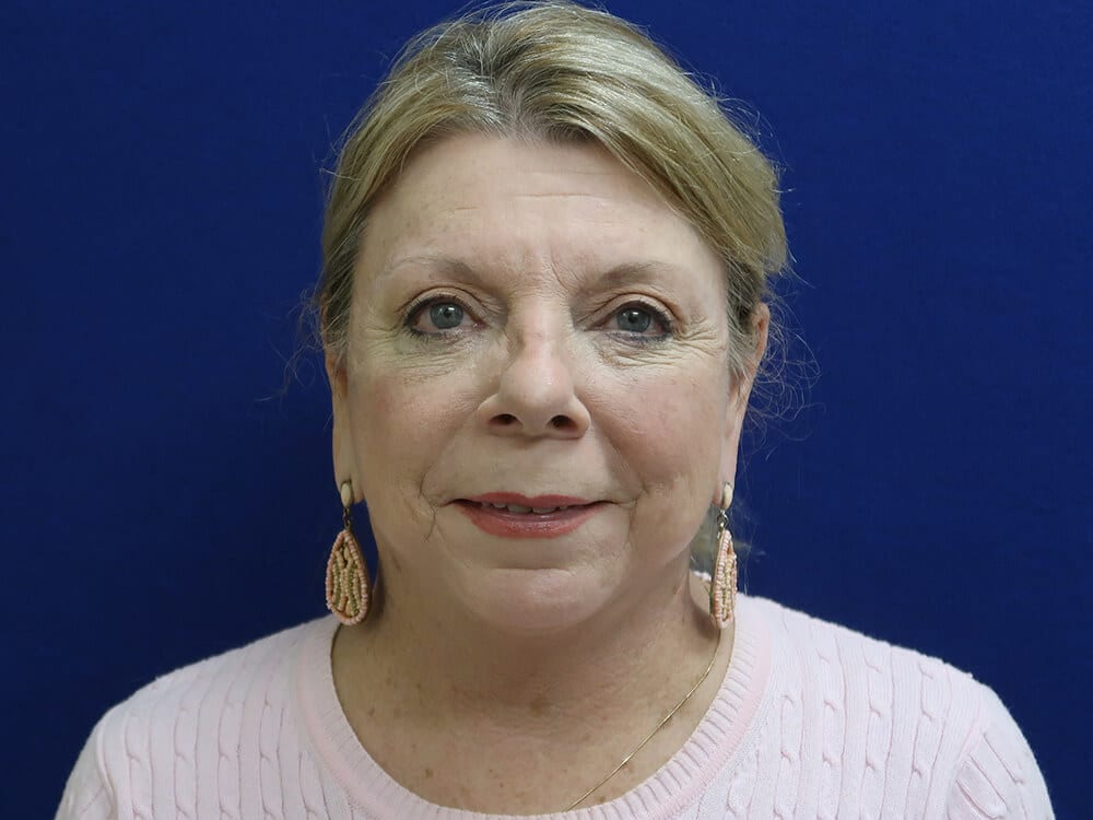 Case #4847 - Wilson Plastic Surgery