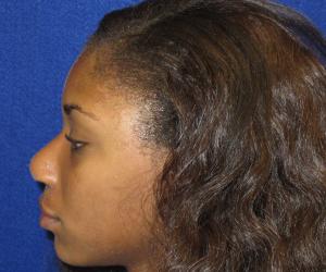 Case #3318 - Wilson Plastic Surgery