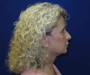 Case #8619 - Wilson Plastic Surgery