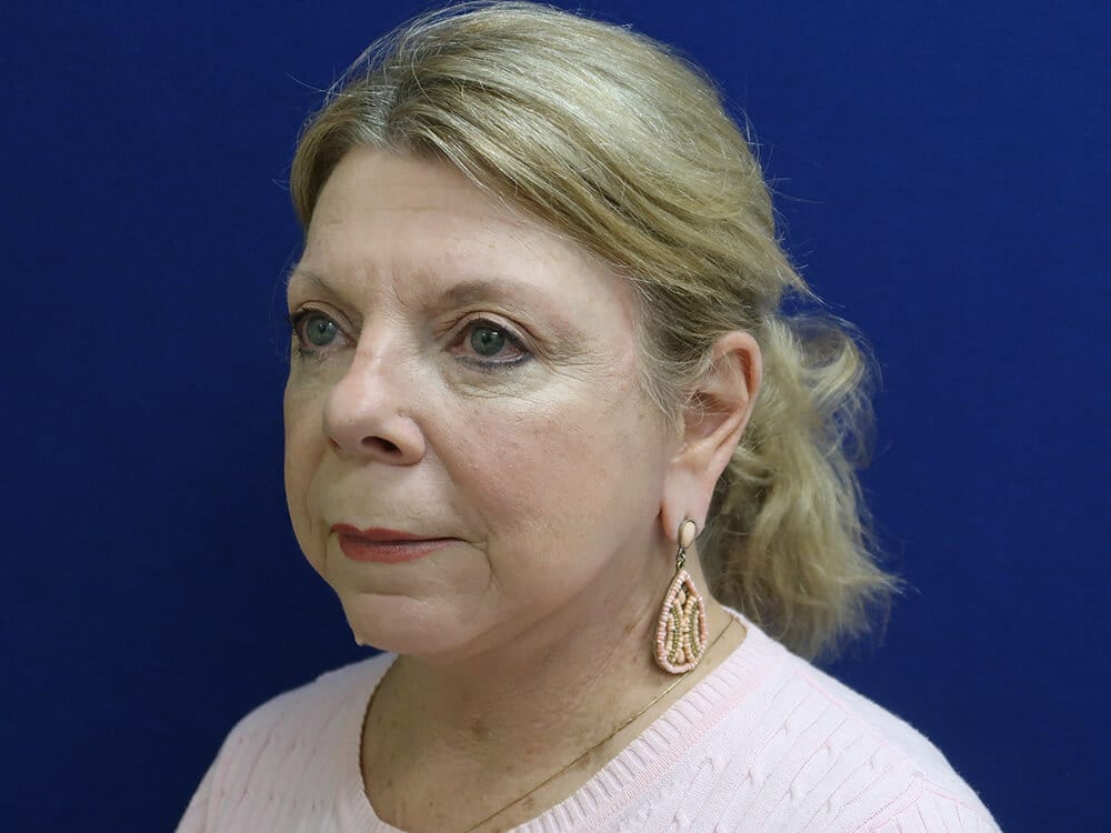 Case #4847 - Wilson Plastic Surgery